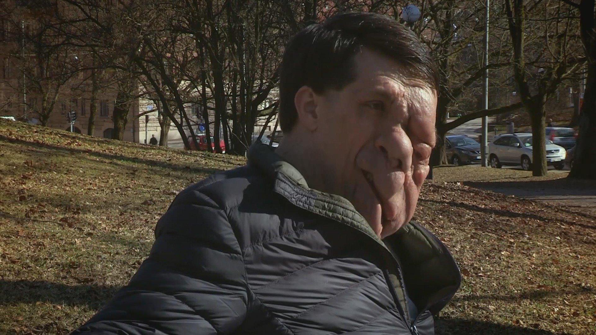 Body Bizarre: My Deadly Face Tumor